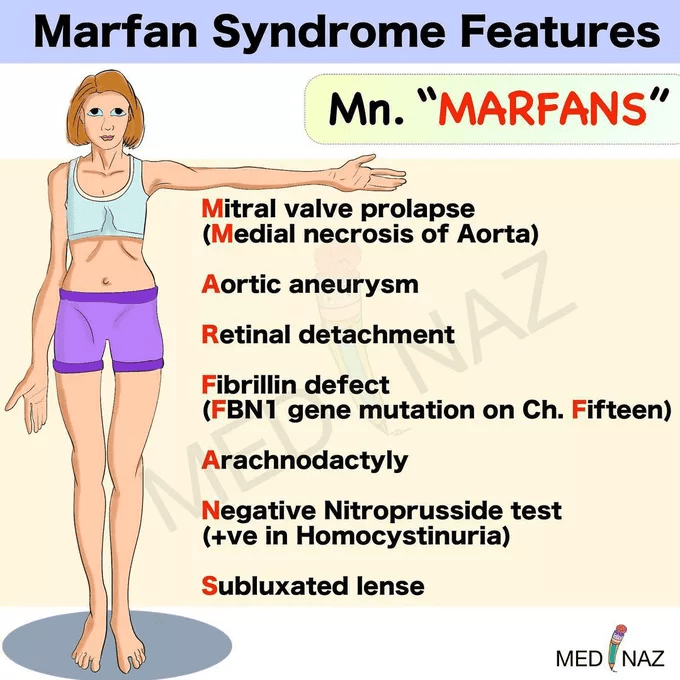 Marfan syndrome | DentMistry