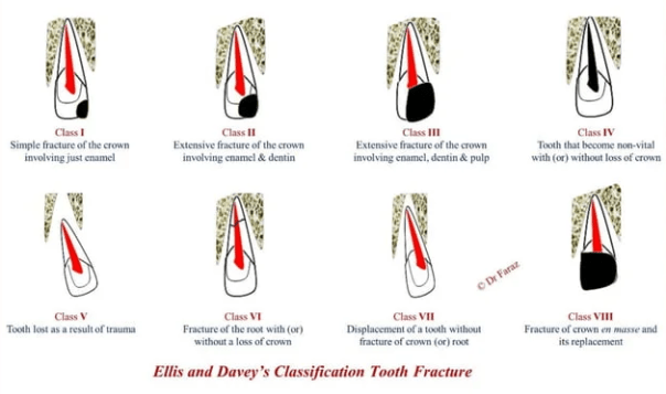 Fractures and trauma | DentMistry
